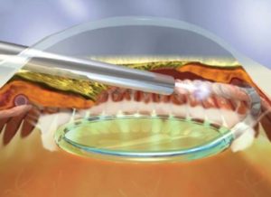 Important Coding Changes for 2020 | Optometric Billing Solutions